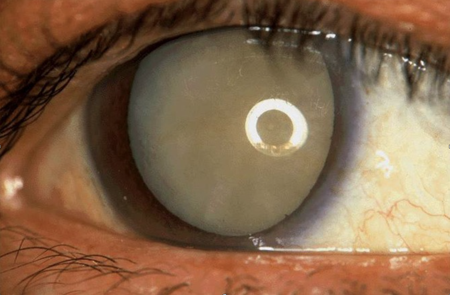 What is a cataract? | Cataract, Laser & Corneal Surgeon